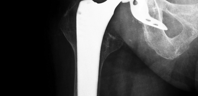 Potential Side Effects of Metal-on-Metal Hip Replacements