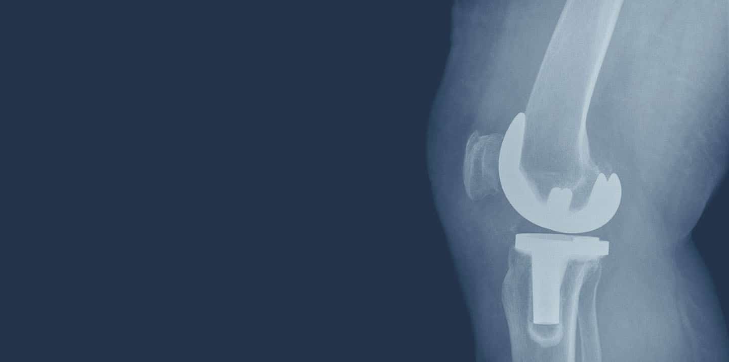 DePuy Attune Lawsuit - Device Failure & Revision - Attorney Group